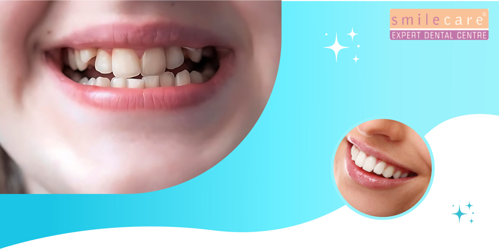 Best Dentist In Bandra West | Smile Care India